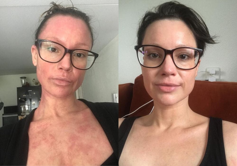 Jeukende bultjes verminderen met Nucleus Coaching